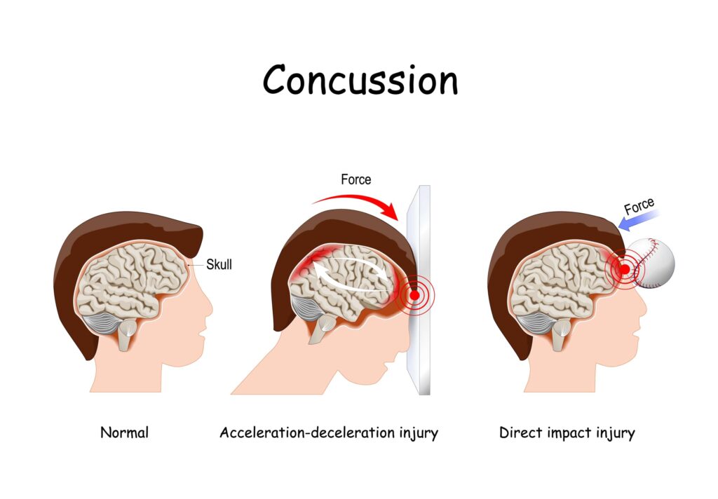 Concussions in Women Can Have Lasting Effects - Premier Neurology ...