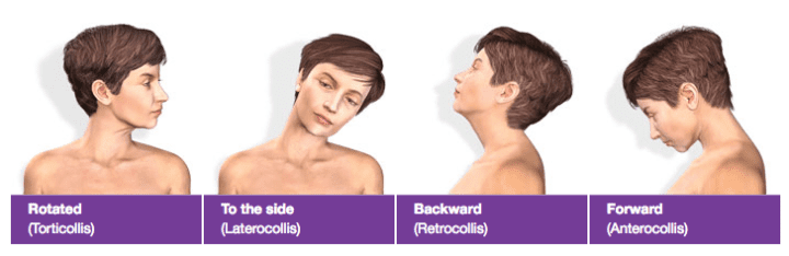 Forms of Dystonia and Their Treatment - Premier Neurology & Wellness Center