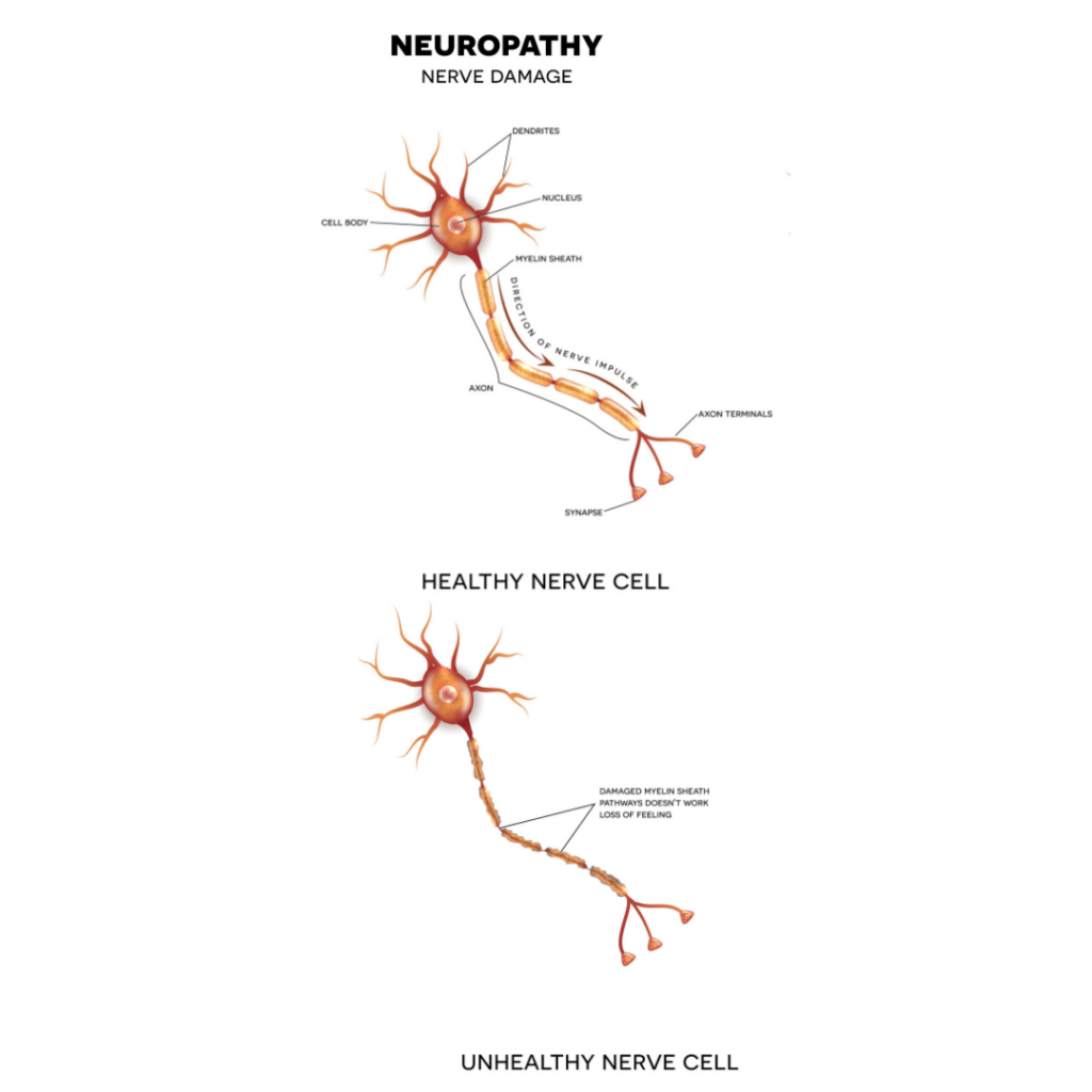 What are the Most Common Causes of Nerve Damage? - Premier Neurology ...