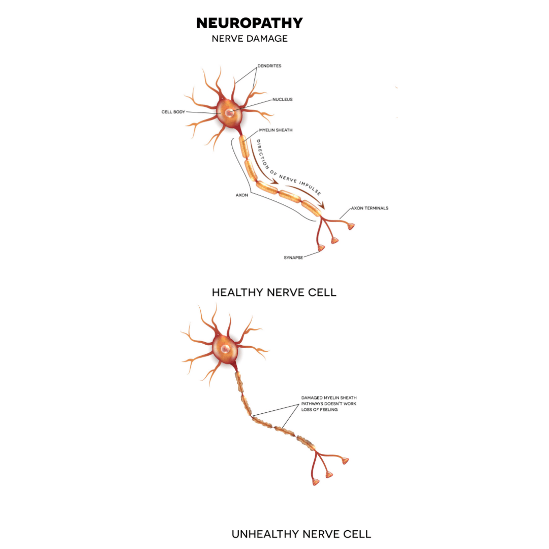 What are the Most Common Causes of Nerve Damage? - Premier Neurology ...