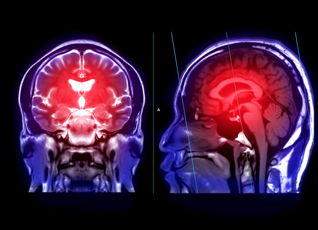 Neurology Blog | Neurological Disorders | Helpful Articles
